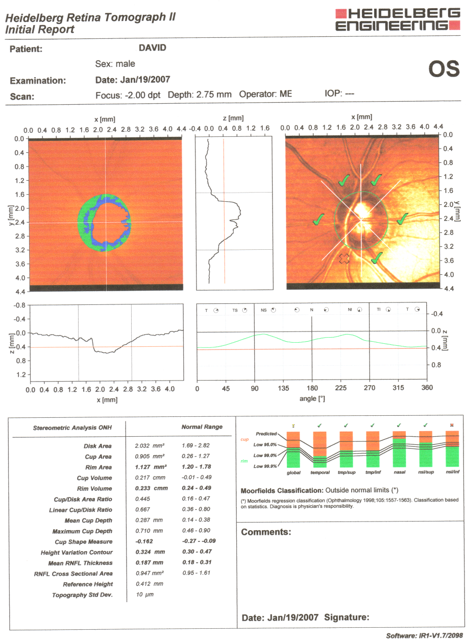 My Heidelberg Retina Tomograph (HRT-II) Results for 2007 | FitEyes.com